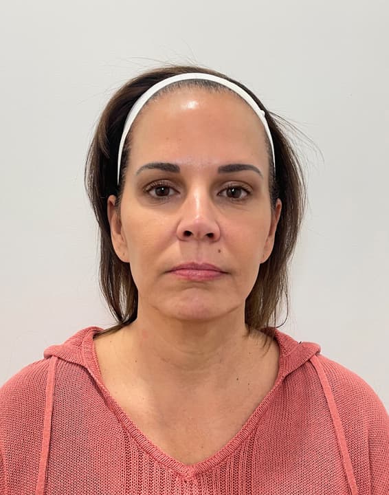 Agnes RF | Radiofrequency Technology | Skin Social